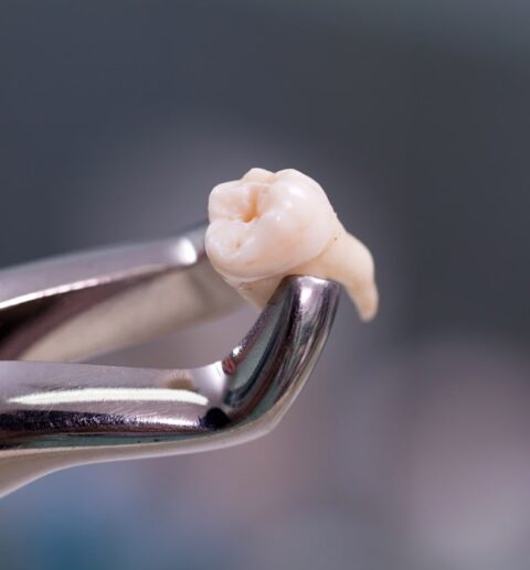 Teeth Extractions - Towne Dental